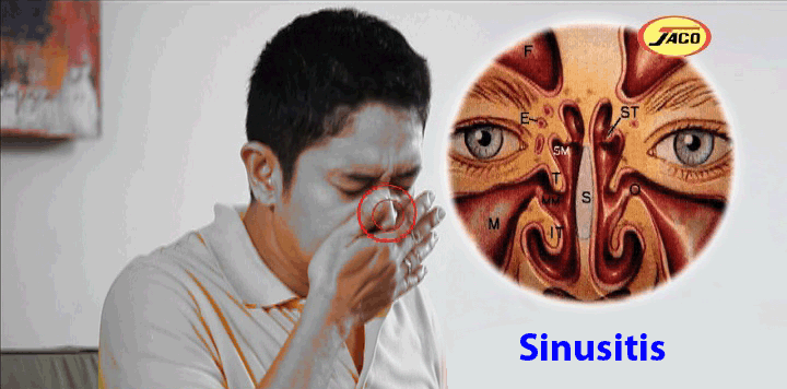 Cara Mengatasi Hidung Tersumbat | CARA MENGATASI