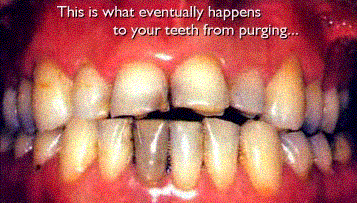 EATING DISORDERS, UNDERSTANDING BULIMIA,