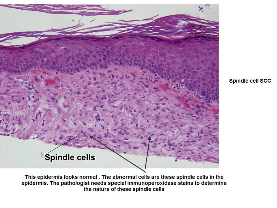 Dermpath Made Simple - Neoplastic: Squamous cell Carcinoma