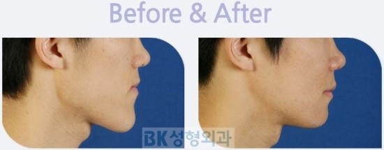 BK Plastic Surgery: Protruding chin correction
