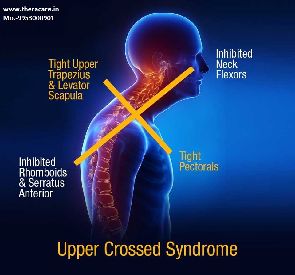 TheraCare-Where Care Comes First: UPPER CROSS SYNDROME AND ITS CLINICAL ...