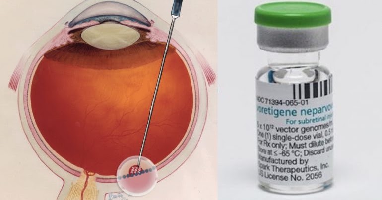 STARGARDT... e dintorni.: Luxturna e Retinite Pigmentosa: promessa ...