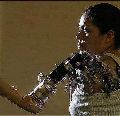 This Women Is First To Have A Bionic Arm Which Can Be Controlled By Brain