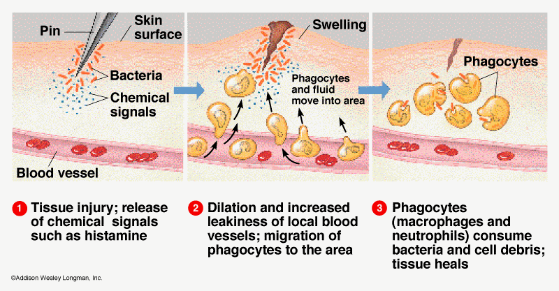Dunia OKU: Apa itu "inflammation"?