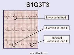 Adult Emergency Medicine: Pulmonary Embolism
