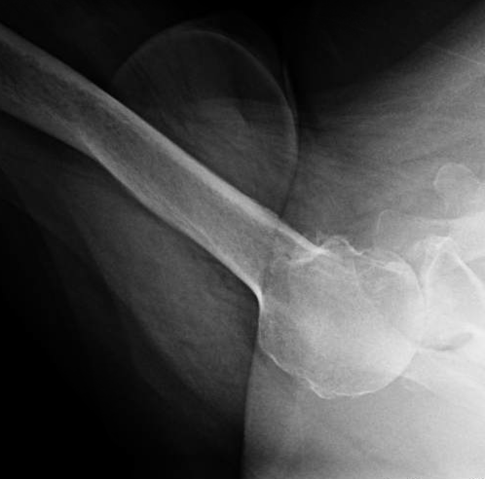 UW Shoulder and Elbow Academy: Glenoid retroversion - how to measure it ...