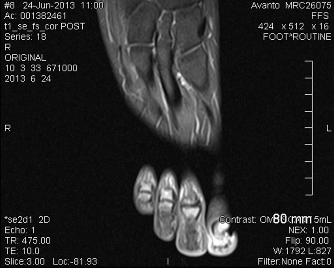 wtf is wrong with my toe???: Toe MRI