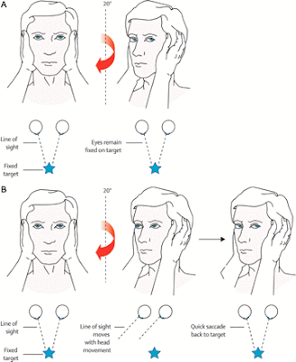 Northland Ear Nose and Throat: Head thrust test- an important test for ...