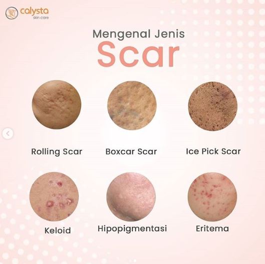 mengenal jenis scar