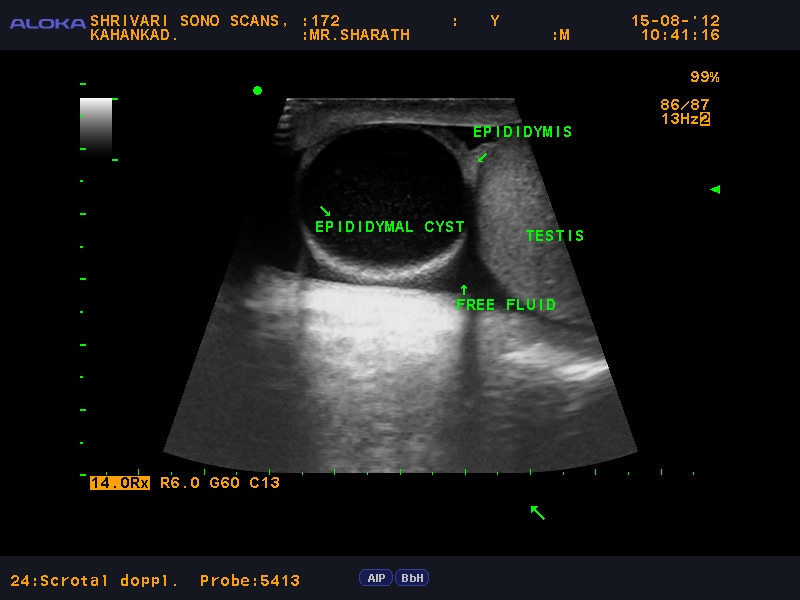 Shrivari Sono Scans: Hrsg scrotum and testis--revealing large ...
