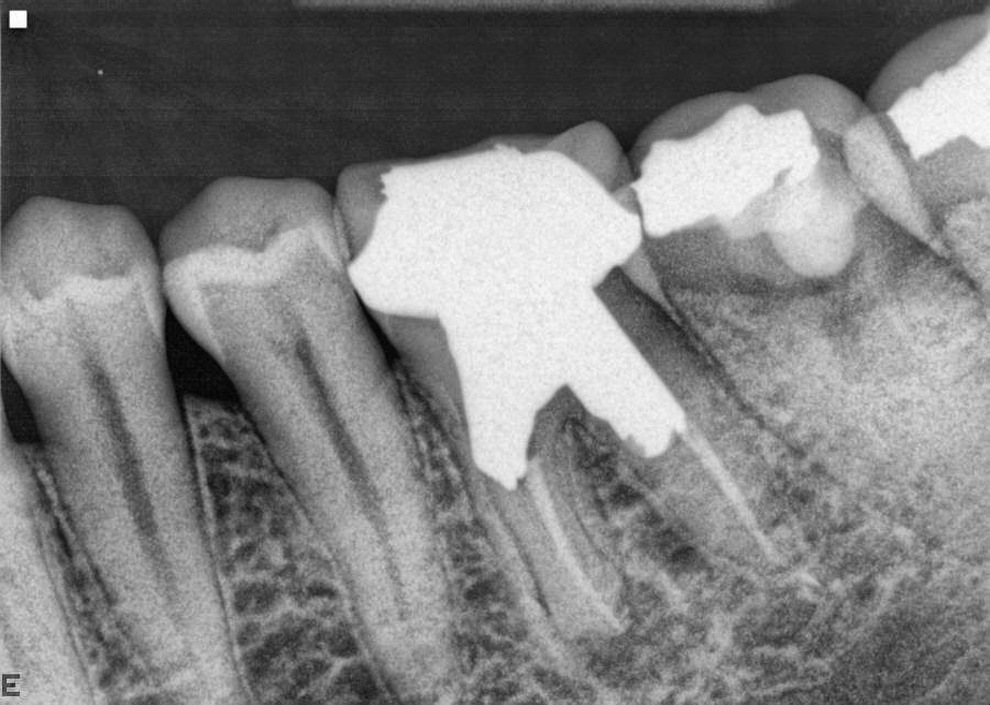 Boyd4Endo: Case 44 Incomplete root canal under crown