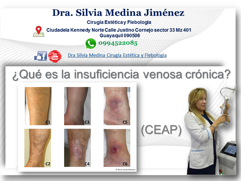 Insuficiencia Venosa Crónica / CEAP