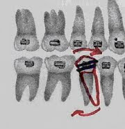 practical orthodontics: Bracket repositioning