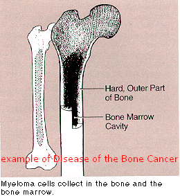 Disease of the Bone Cancer