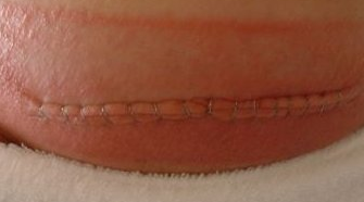 Hilangkan Parut Keloid dengan ESP! | Natural Vitamins For All