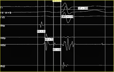 MUSC EP Education: How to Measure Basic Intervals