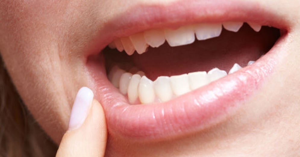 Penyebab, Gejala Kanker Mulut dan Pengobatannya | Health and Hope