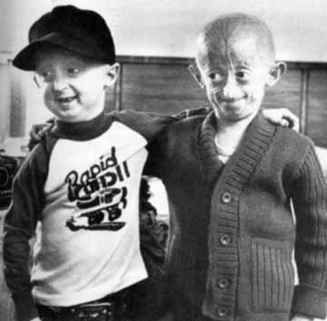 Progeria history, including definition, causes, and symptoms - nyforall