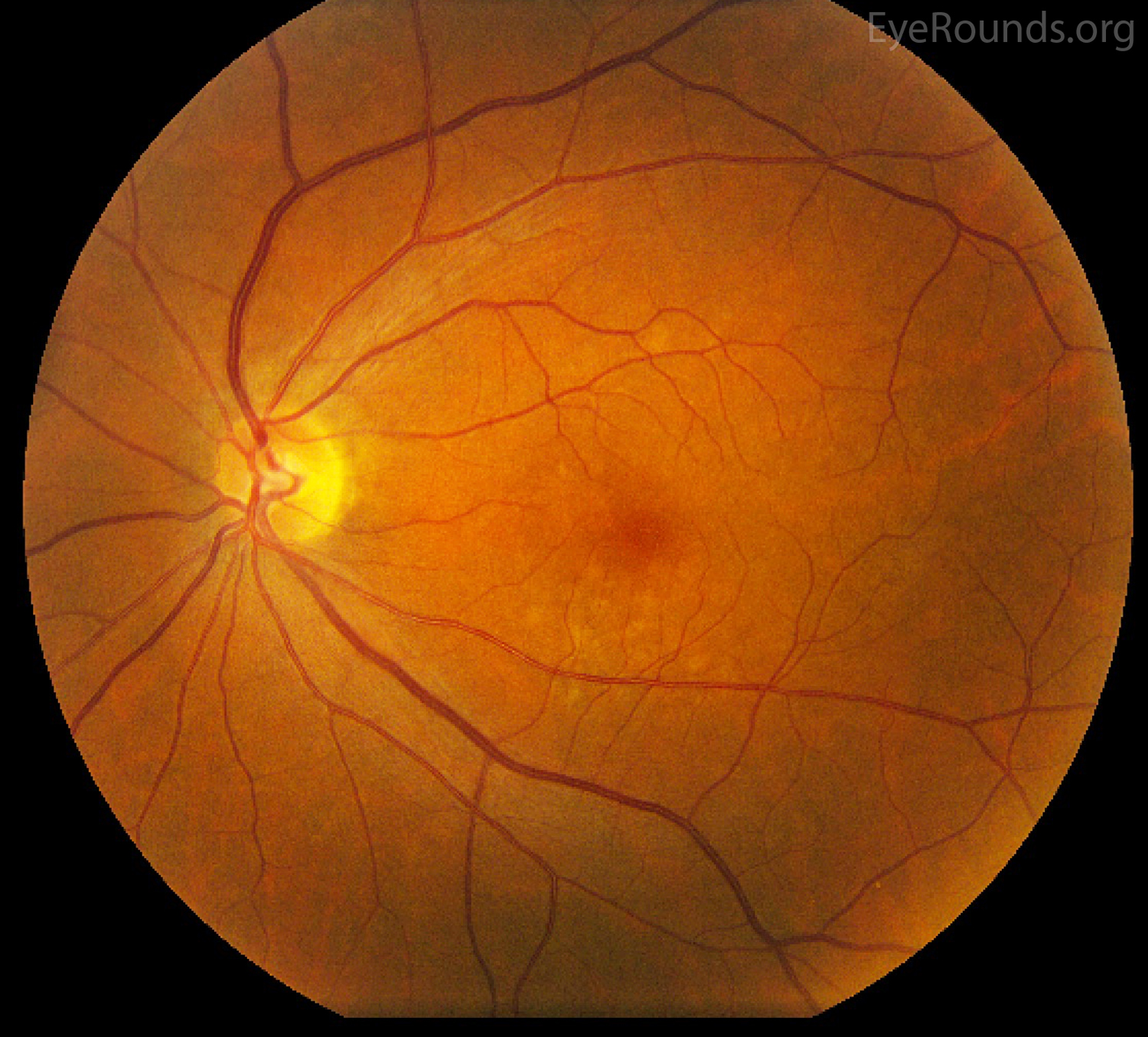 Age-related Macular Degeneration Typically Affects the Central Portion ...