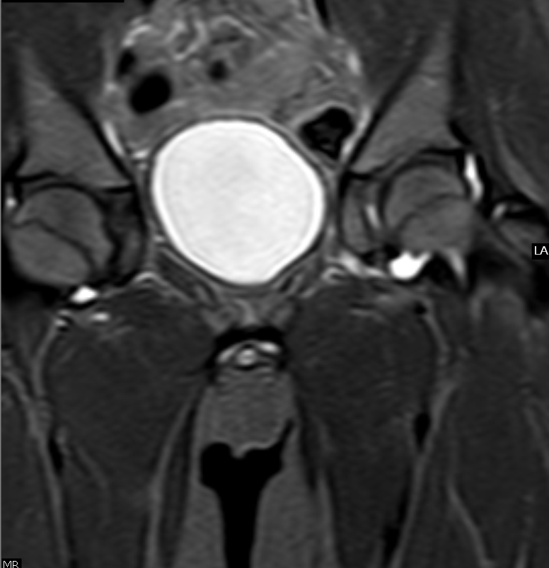 Transient Synovitis-Plain Film & MRI - Sumer's Radiology Blog