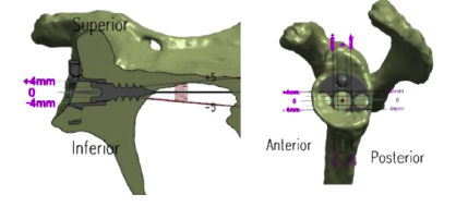 UW Shoulder and Elbow Academy: Patient specific instrumentation - is it ...