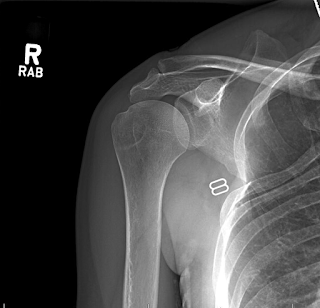 Shoulder and Elbow Surgery: Sprengel Deformity in adulthood