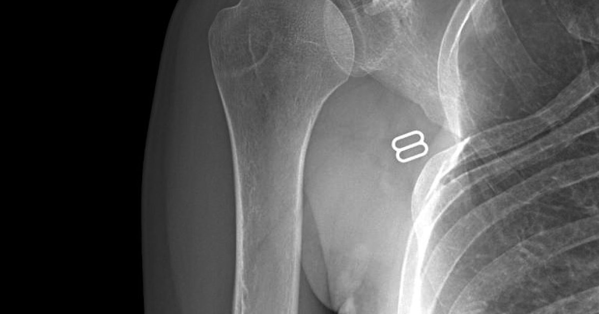 Shoulder and Elbow Surgery: Sprengel Deformity in adulthood