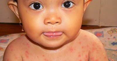 Obat Cacar Api Pada Anak ~ Obat Bronkitis Pada Anak