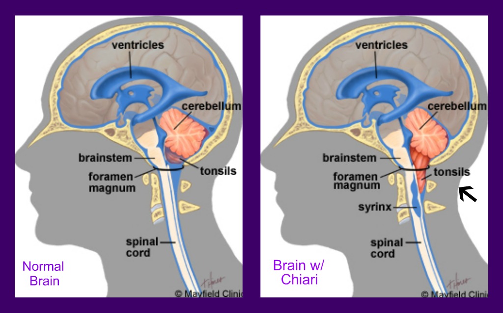 Genes That Don't Fit!: Chiari Malformation