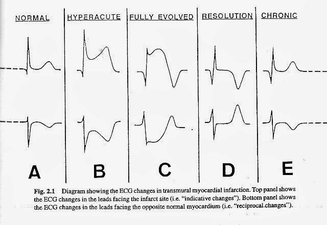 Gambaran EKG Pasien Dengan Angina Pectoris | DUNIA KEPERAWATAN