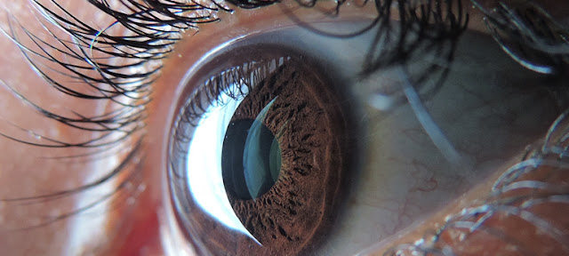 Corneal Cross Linking Perfect Treatment For Keratoconus