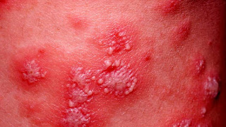 Generalized pustular psoriasis