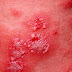 Generalized pustular psoriasis