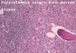 Case Study (5)- Polycythemia vera