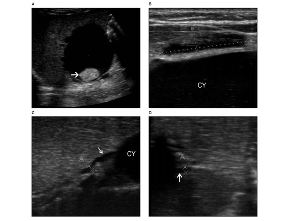 BÀI SOẠN VỀ SIÊU ÂM CHẨN ĐOÁN: Sonographic Findings of Cystic Biliary ...