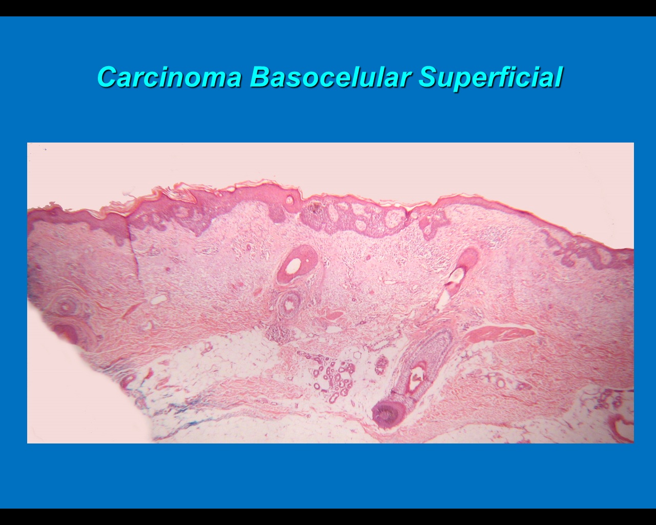 Dermatopatologia: CARCINOMA BASOCELULAR