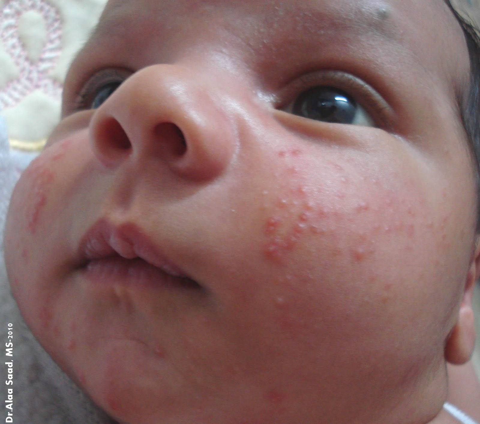 916SKIN - ACNE SKIN & WELLNESS CLINIC: What Causes Some Babies To Have ...