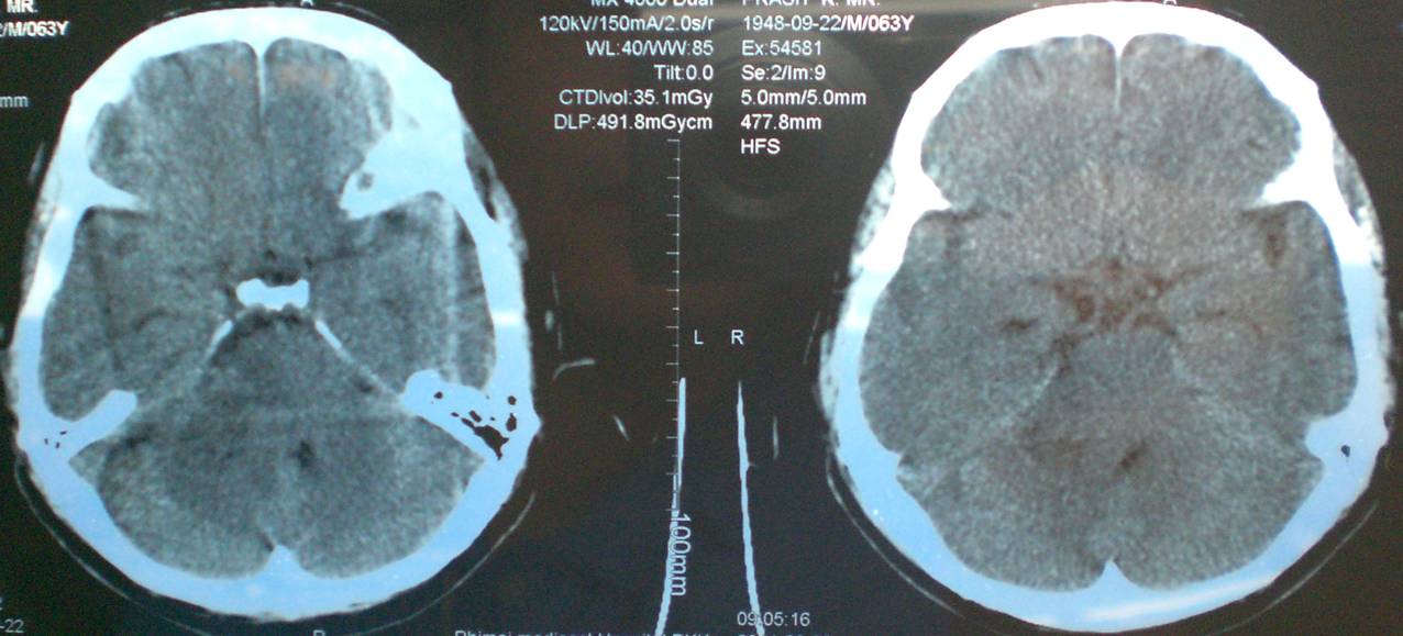 Phimaimedicine: 1,353. Cerebellopontine angle tumor (schwannoma)