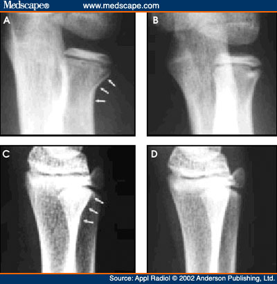 Vickie - My Journey: Buckle Fracture