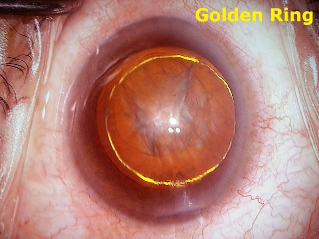 Ophthalmology Notes: SPOTS & DOTS in Ophthalmology