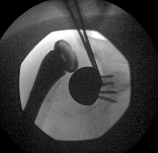 Shoulder Arthritis / Joint Replacement : Dislocation after reverse ...