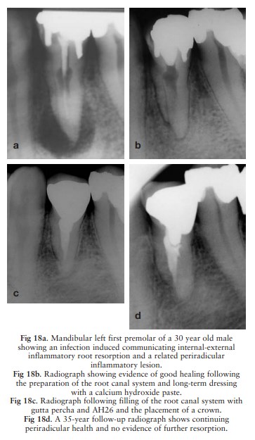 Endodontic: Communicating internal-external inflammatory resorption