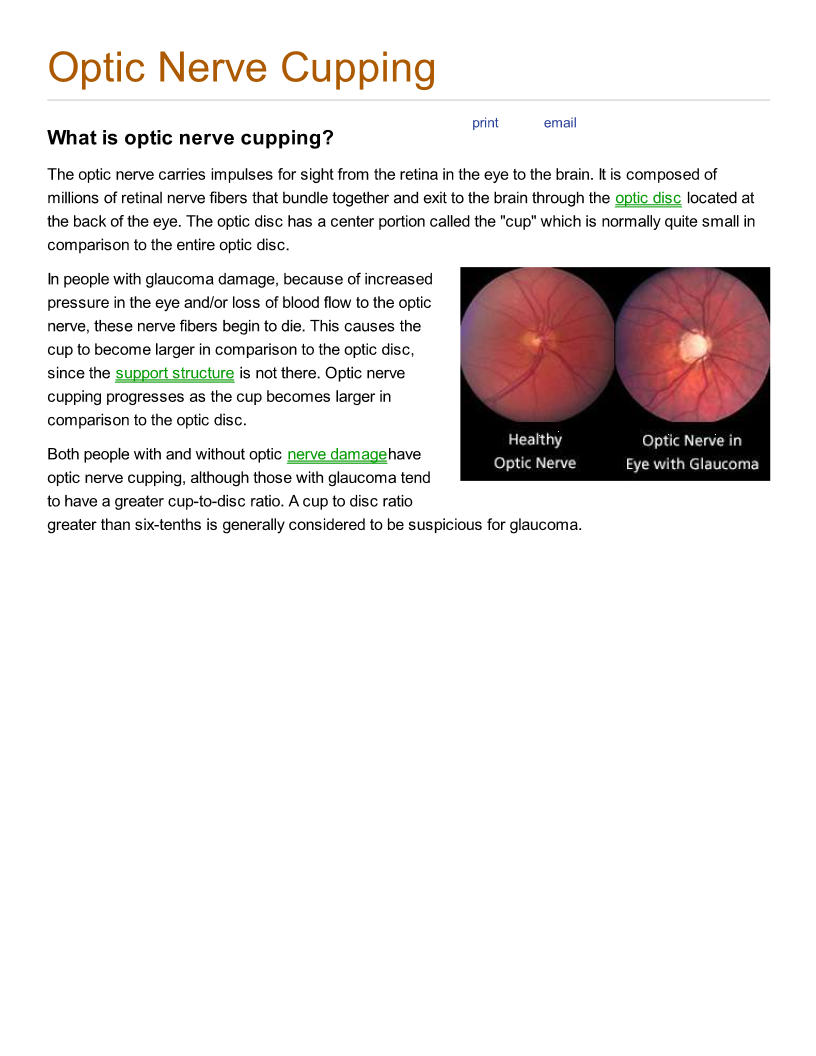 Medical Facts: Optic nerve cupping