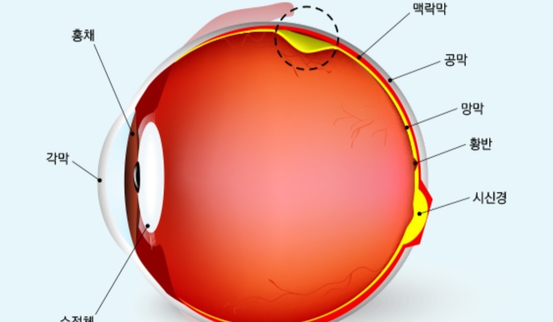 Ablasi Retina: Penyebab, Gejala, Diagnosis, Komplikasi, Pencegahan ...