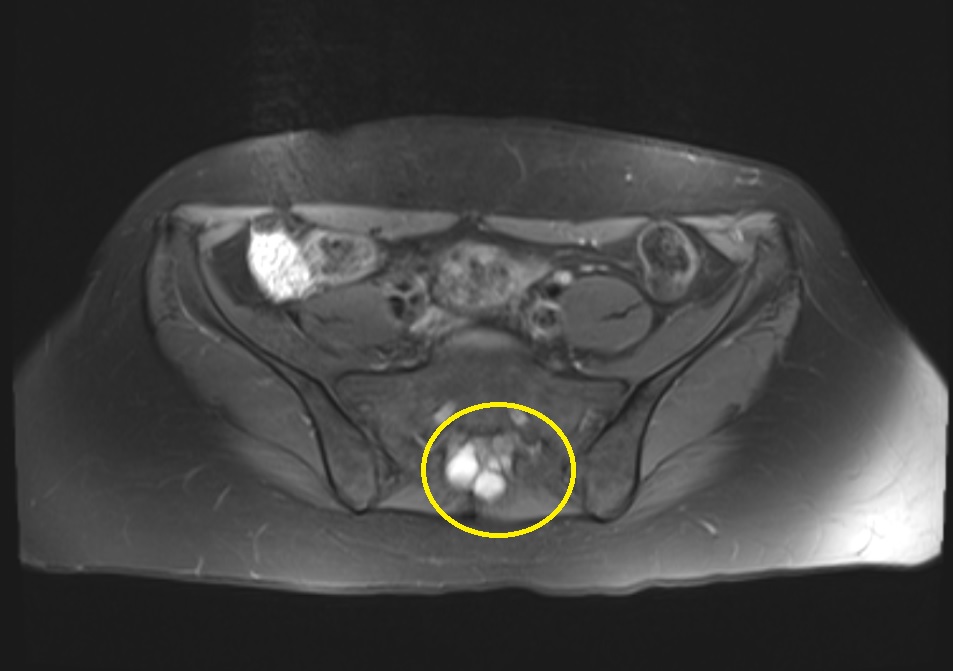 Tarlov Cyst Disease - Making it One Day at a Time: I Have a WHAT-A-Hooey?