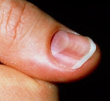 20 Warning Signs And Symptoms Of Anemia You Might Not Be Aware