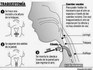 Asociación Barcelonesa de Laringectomizados: ¿Qué es una traqueotomía?