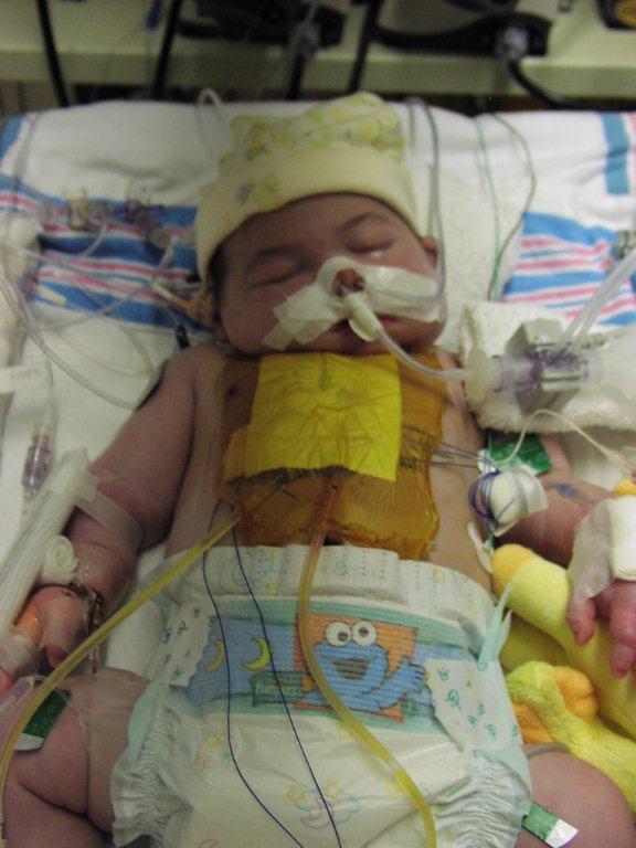 CHD Blog : www.One in 1 Hundred.: Post-Op Pics