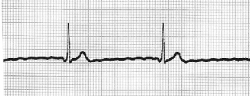 ECG Made Easy(Part-2)