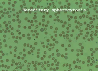 Hereditary spherocytosis (HS)